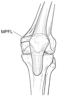 MPFL Reconstruction | Robert Steensen, MD